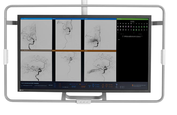 Aneurysm, pulmonary embolism and stroke software platform powered by AI