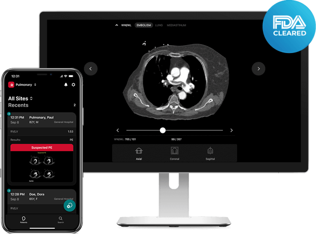 Aneurysm, pulmonary embolism and stroke software platform powered by AI