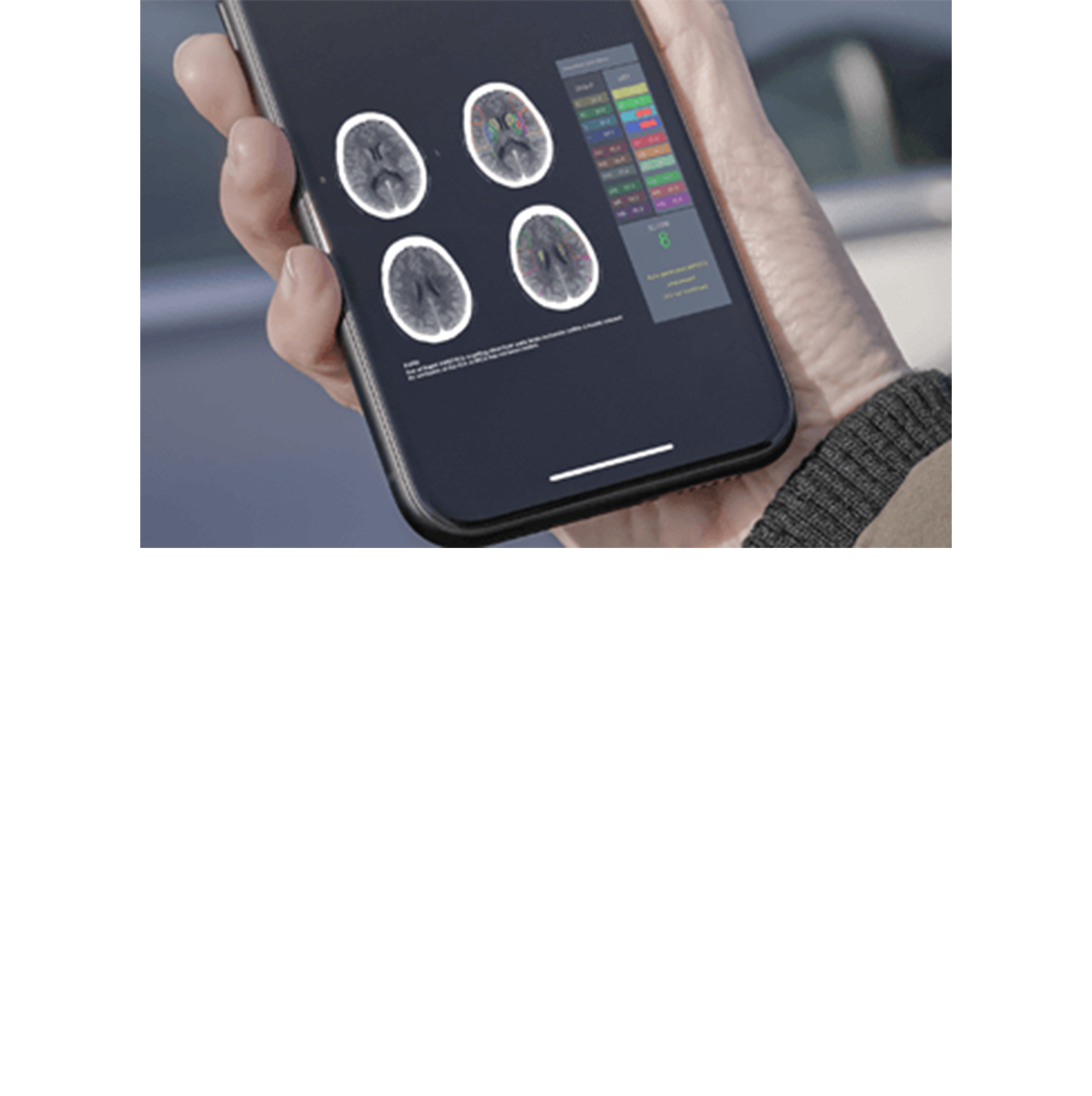 Neuroimaging Stroke Software Platform Powered by AI | RapidAI