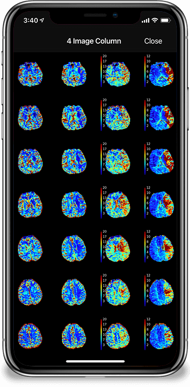 Neuroimaging Stroke Software Platform Powered by AI | RapidAI