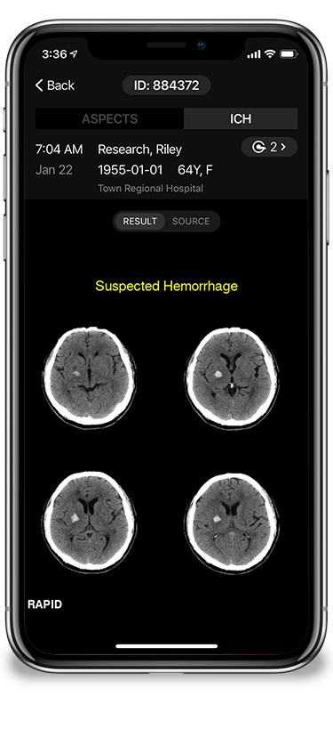 Neuroimaging Stroke Software Platform Powered by AI | RapidAI
