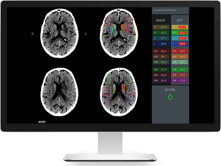 Neuroimaging Stroke Software Platform Powered by AI | RapidAI Neuroimaging Stroke Software Platform Powered by AI | RapidAI
