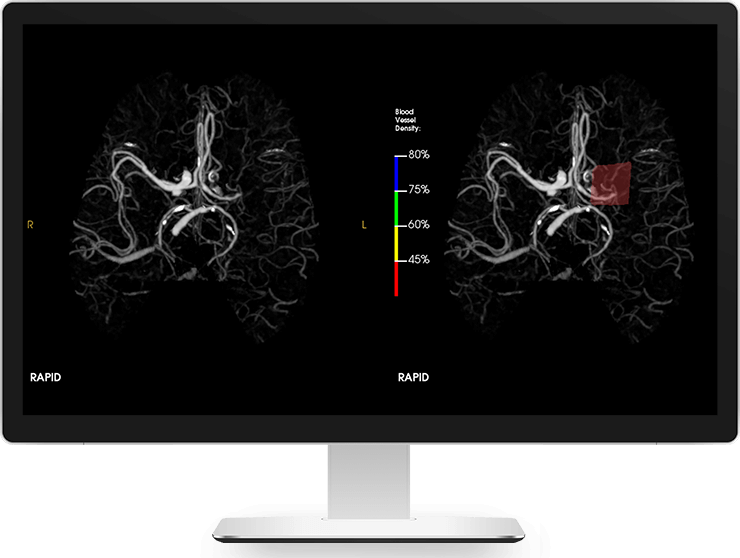 Neuroimaging Stroke Software Platform Powered by AI | RapidAI
