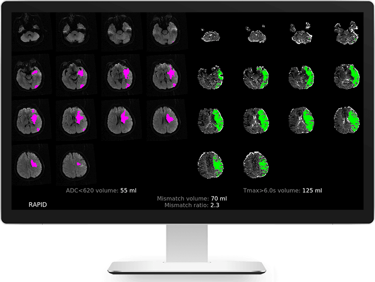 Neuroimaging Stroke Software Platform Powered by AI | RapidAI